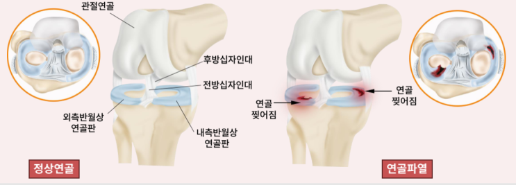 더밸런스한의원 무릎 연골파열 Vs 퇴행성관절염 Vs 슬개건염 추나 대치동한의원 네이버 블로그