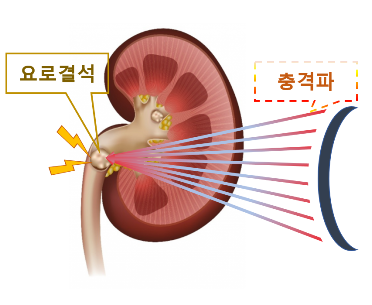 울산 비뇨기과 요로 결석 신장 결석 치료법 결석 파쇄기 체외 충격파 쇄석술 Eswl 네이버 블로그