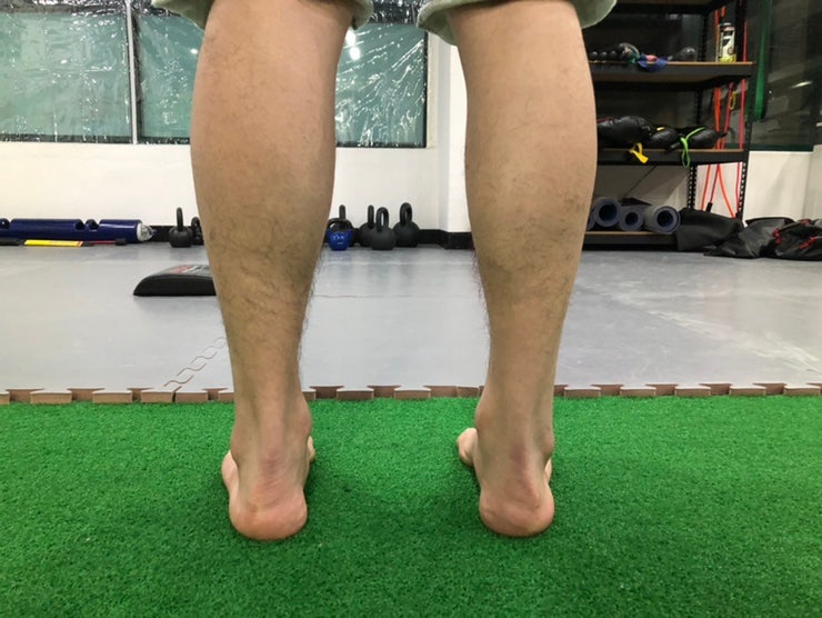 요족의 2가지 케이스(Rearfoot varus) : 네이버 블로그