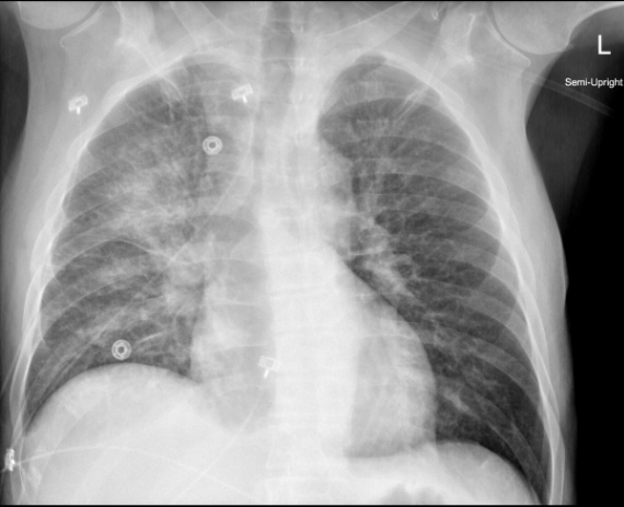 승모판 역류증, 엑스레이 & 심전도, 치료, Acute MR, chest & ECG, treatment : 네이버 블로그