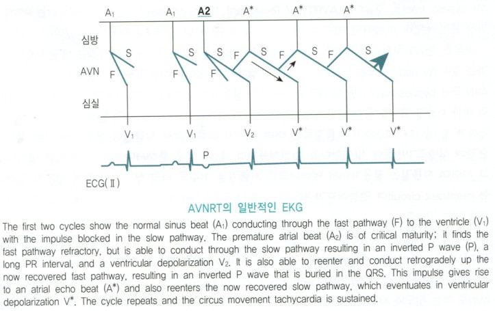 paroxysmal supraventricular tachycardia(PSVT, 발작성 심실상성 빈맥) : 네이버 블로그