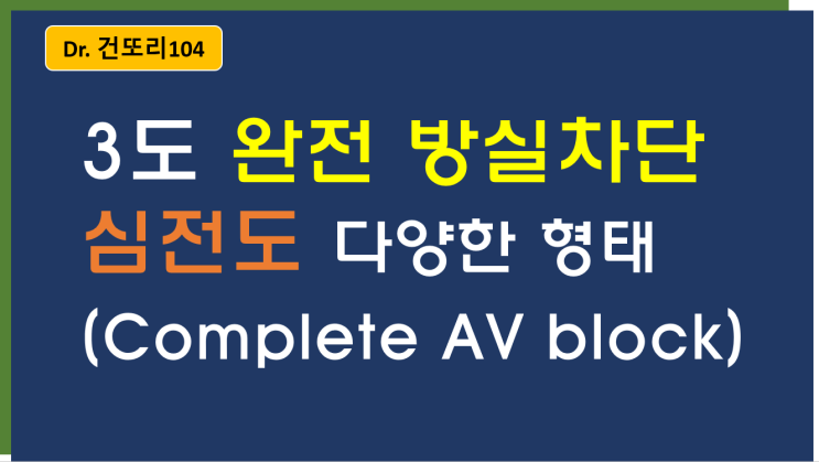 3도 완전방실차단complete Av Block 심전도 기본과 응용with 심방세동 심근경색 혼합형 네이버 블로그
