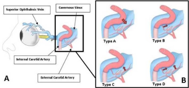 경동맥해면정맥동루 CCF(Carotid Cavernous Fistula) : 네이버 블로그