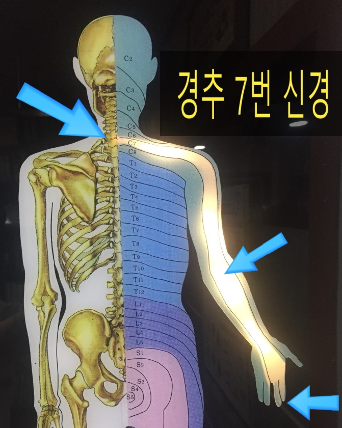 좌측 검지 저림 팔꿈치 통증 목통증 어깨통증 2020 3 2 목디스크 2주 입원치료 후 내원 교통사고 치료 네이버 블로그