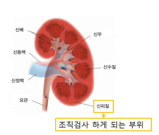 신장콩팥 조직 검사란 무엇인지 궁금해요 네이버 블로그