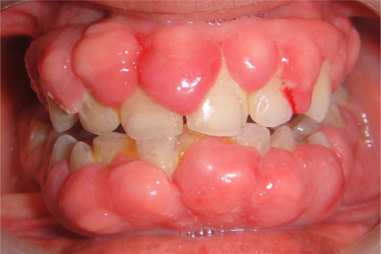 잇몸비대증(gingival enlargement) : 네이버 블로그