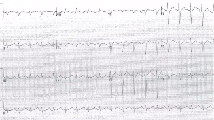 [심전도] 삼환계항우울제 중독, [ECG] TCA poisoning : 네이버 블로그