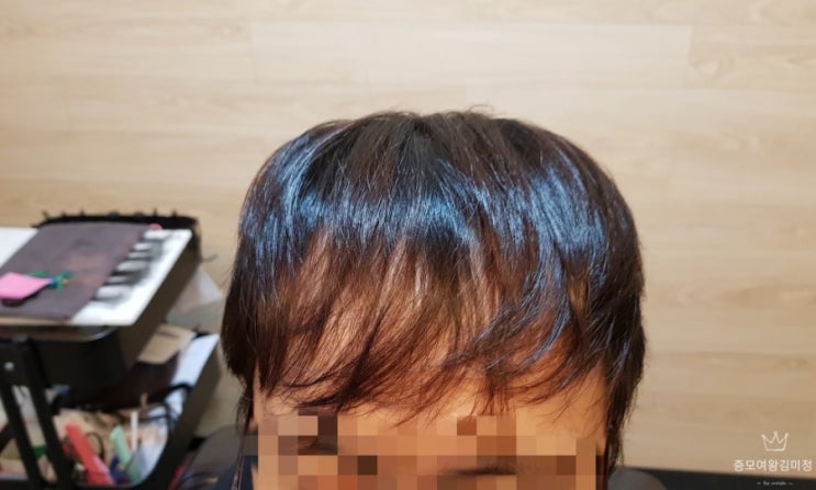 이마넓은 남자 머리 헤어증모술 실패없이 커버하기 네이버 블로그