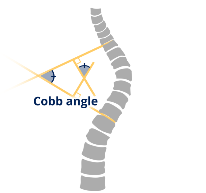 [ 창원 척추 측만증 ] 척추 측만증을 평가하는 방법 - Cobb's Angle 재는 방법. : 네이버 블로그