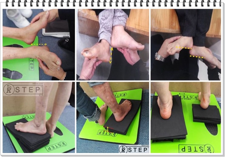 다리길이로 차이로 인한 골반통증 다리길이 교정 신발 깔창으로 맞춤 보정 네이버 블로그