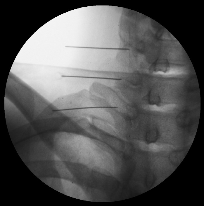 목 통증 - 목디스크 - 경추내측후지차단술 (Cervical MBB) - 구의동 근본 정형외과 : 네이버 블로그