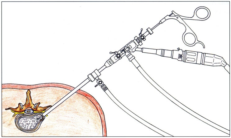 경피적 내시경 추간판제거술(PELD) : 네이버 블로그