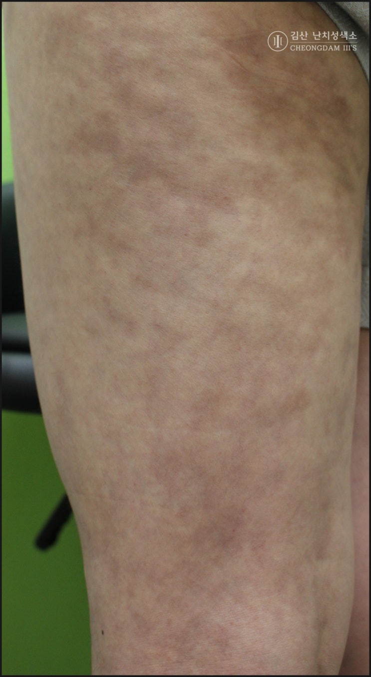색소침착과 감별할 질환 1- atrophoderma(피부위축증) : 네이버 블로그