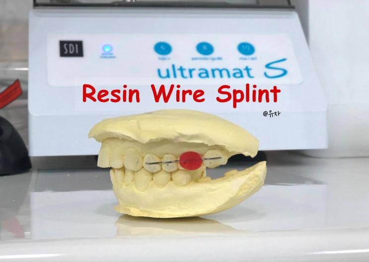 치과업무일지 / 레진 와이어 스플린트 (resin wire splint) / 잠간고정술 (temporary splinting ...