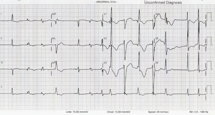 Alternating Bundle-Branch Block : 네이버 블로그