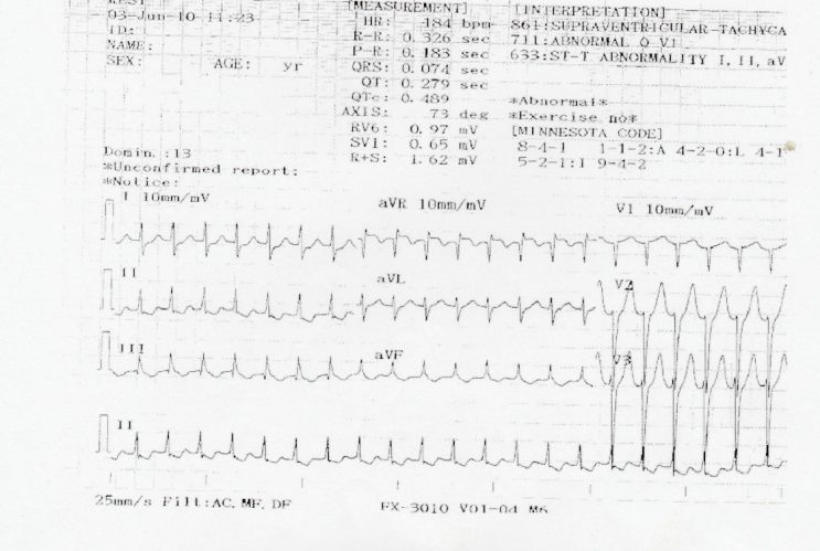 PSVT in WPW : 네이버 블로그