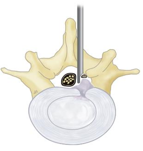 척추 내시경 (PELD, PSLD, 양방향 척추 내시경) : 네이버 블로그