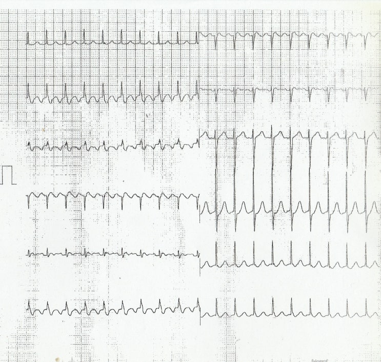 Atrial Flutter 2 1 Block 네이버 블로그