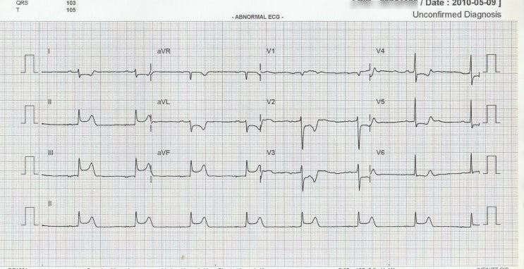 변이형협심증, 심전도, Variant angina, ECG : 네이버 블로그