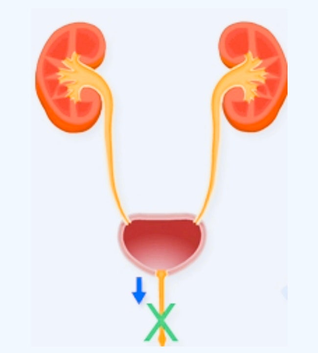 Cystostomy(요로전환술,방광창냄술)에 대하여 : 네이버 블로그