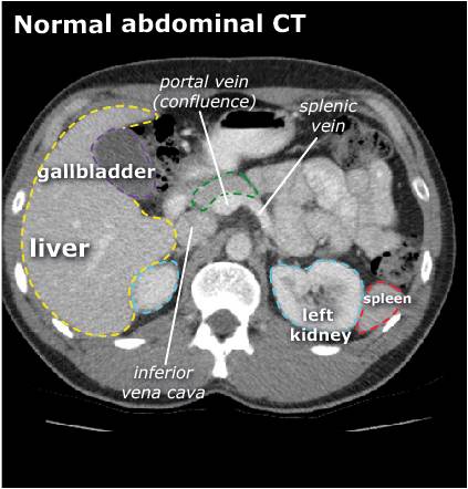 Normal abdominal CT 3 : 네이버 블로그