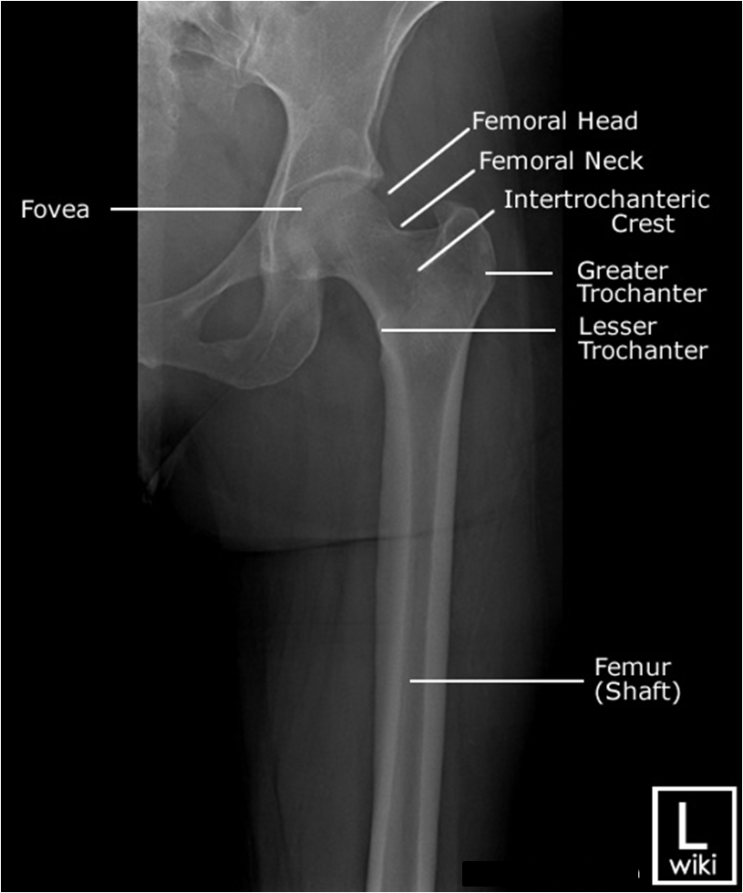 Adult Femur - AP Proximal View : 네이버 블로그