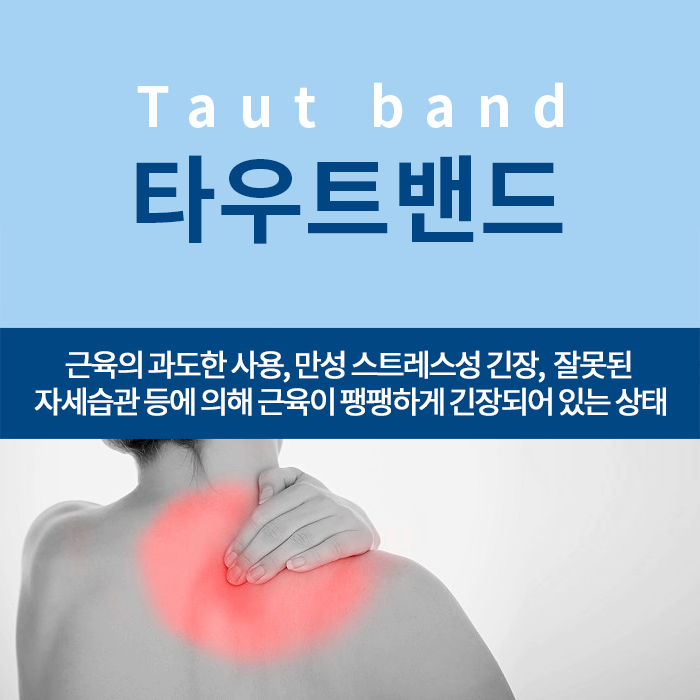 근육의 긴장띠, 스트레스 근육 '타우트밴드'(Taut band) : 네이버 블로그