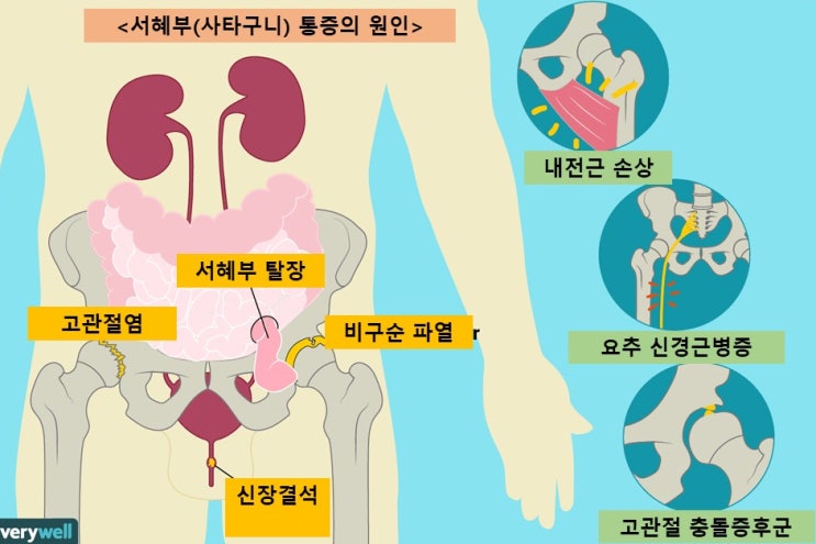 사타구니서혜부 통증의 원인과 치료 및 관리 고관절 내전근 손상축구 태권도 부상 네이버 블로그