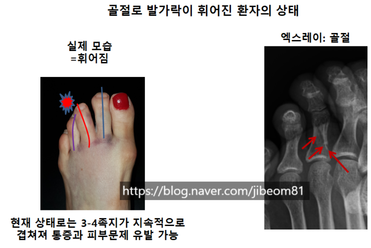 발가락 골절의 비수술적 치료 세번째 발가락이 다친 후 휘어졌어요 수술없이 맞출 수 있나요 족부정형외과 전문의 김지범
