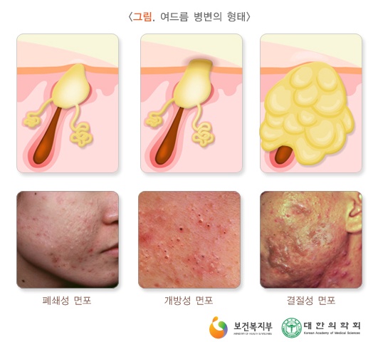 화농성 피부염 여드름과 두드러기 불면증 제주 온기담은 한의원 네이버 블로그