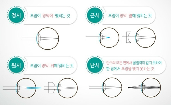근시 원시 난시 내 눈은 어떤 눈일까 네이버 블로그