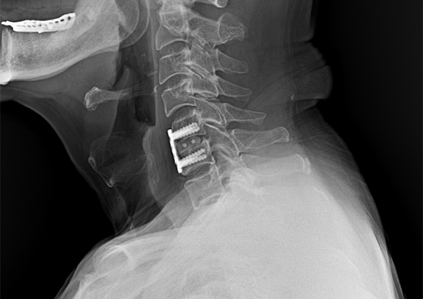 목디스크 수술방법 경추골유합술(ACDF)이란? : 네이버 블로그