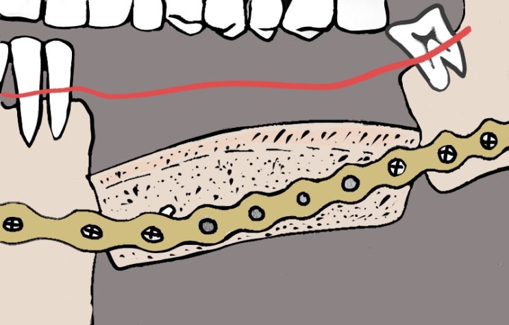 골반뼈를 이용한 턱뼈재건 DCIA Flap / 교합의 중요성 : 네이버 블로그