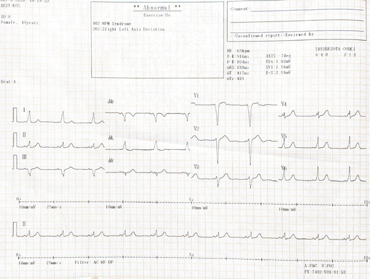 WPW 증후군 (Wolff-Parkinson-White syndrome) 환자의 심전도와 심초음파 : 네이버 블로그