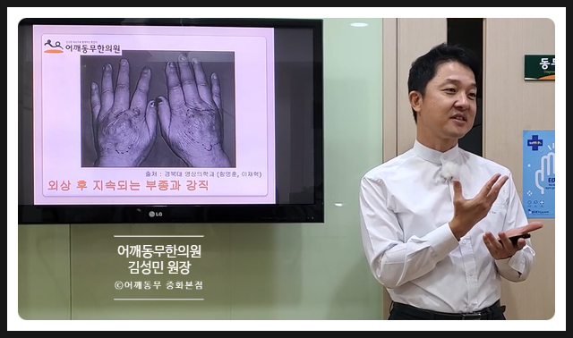 외상 후 부종증후군 (Secretan's syndrome / 다치고 나서 손등 붓기가 안 빠져요) : 네이버 블로그