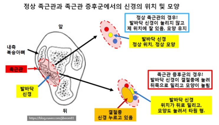거골 종골 족근골 융합족근골 결합 으로 인한 족근관 증후군 수술 사례 발목 내측이 수술 해도 붓고 아프고 쩌릿쩌릿해요