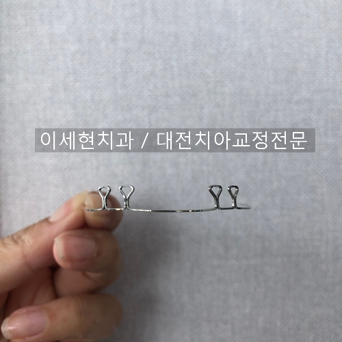 part3. 특수철사 (double keyhole, T-loop, L-loop, MEAW) : 네이버 블로그