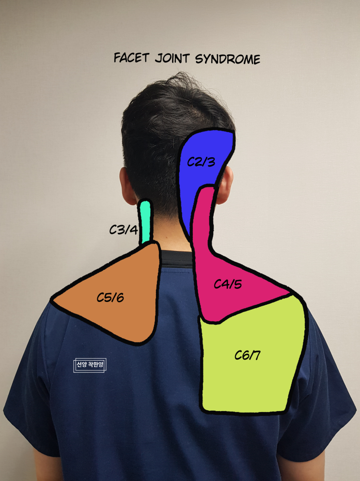 경추 후관절 증후군 Facet joint syndrome 목통증원인 과 프롤로치료 : 네이버 블로그