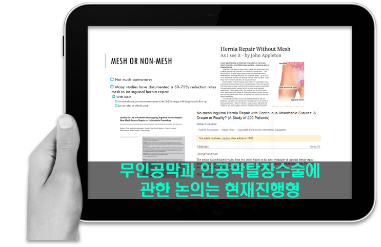 강서구 서혜부 탈장수술 인공막 무인공막 선별적 복강경 탈장교정술로 재발 부담 낮춰 네이버 블로그