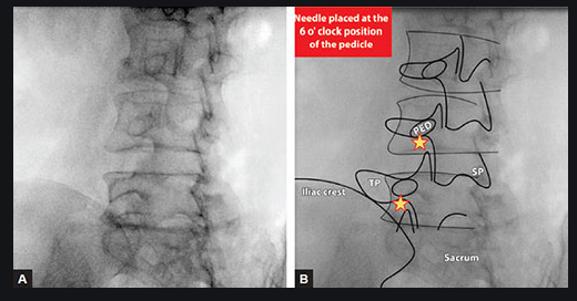 경추간공 경막외 신경차단술 (Transforaminal Epidural nerve block, TFESI) : 네이버 블로그