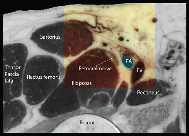US guided femoral nerve block의 해부학적 고찰. : 네이버 블로그