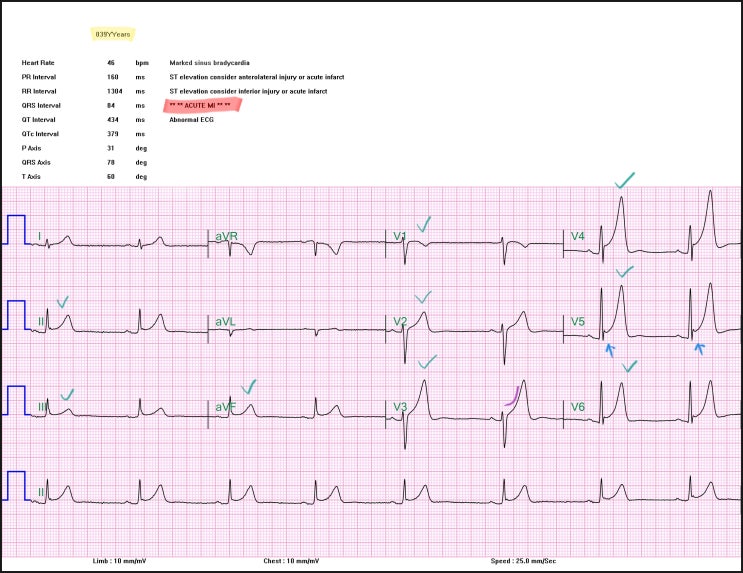 Benign early repolarization (BER, 양성 조기 재분극) : 네이버 블로그