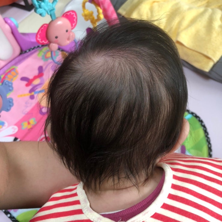 5개월 아기 두개골 조기 유합증 이야기 인천성모병원 방문 및 유합증 진단 네이버 블로그