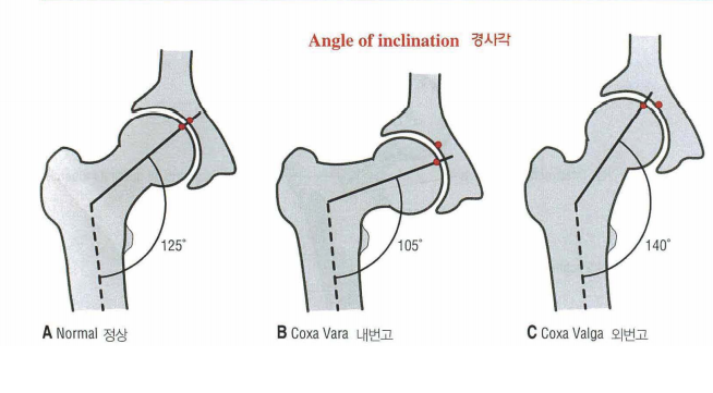 넙다리뼈의 경사각과 비틀림 Coxa vara, Coxa valga, Excessive anteversion ...