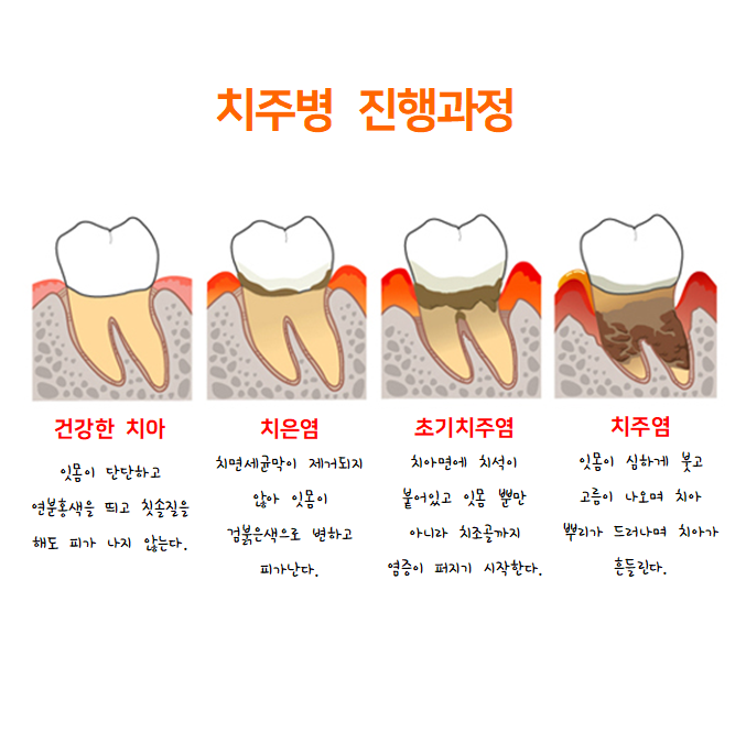 동대문치과 동대문역사문화공원역 치과 건강한 잇몸을 위해 하루에치과치료 끝내는 스케일링 네이버 블로그