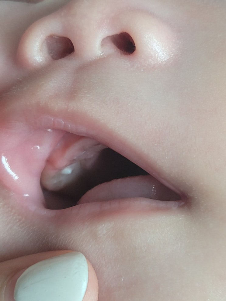 40일아가 진주종(Epstein pearl) 발견, 치료방법 : 네이버 블로그