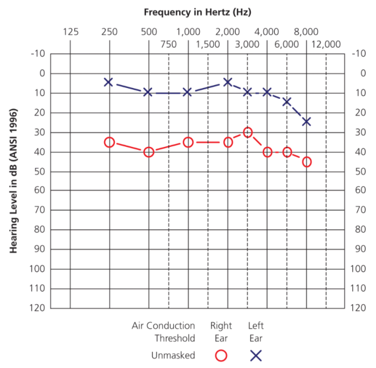 Audiometry Screening and Interpretation - 청력 검사지 해석하기 : 네이버 블로그