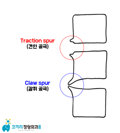 척추의 기능성 단위(Functional spinal unit / FSU)란? 척추의 견인 골극(traction spur)과 갈퀴 ...