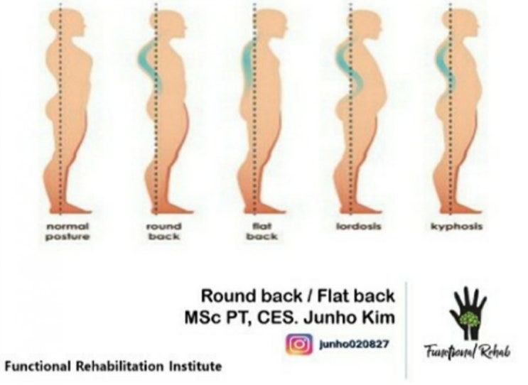 Round back과 Flat back 이 근골격계 문제에 주는 영향 : 네이버 블로그
