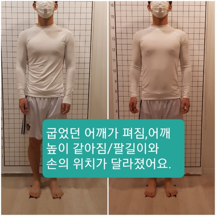 춘천체형교정 보행교정 춘천바른필라테스 1day교정 프로그램 변화보기 네이버 블로그